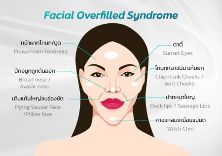 Facial Overfilled Syndrome ล้นจนเกินพอดี - s45 clinic