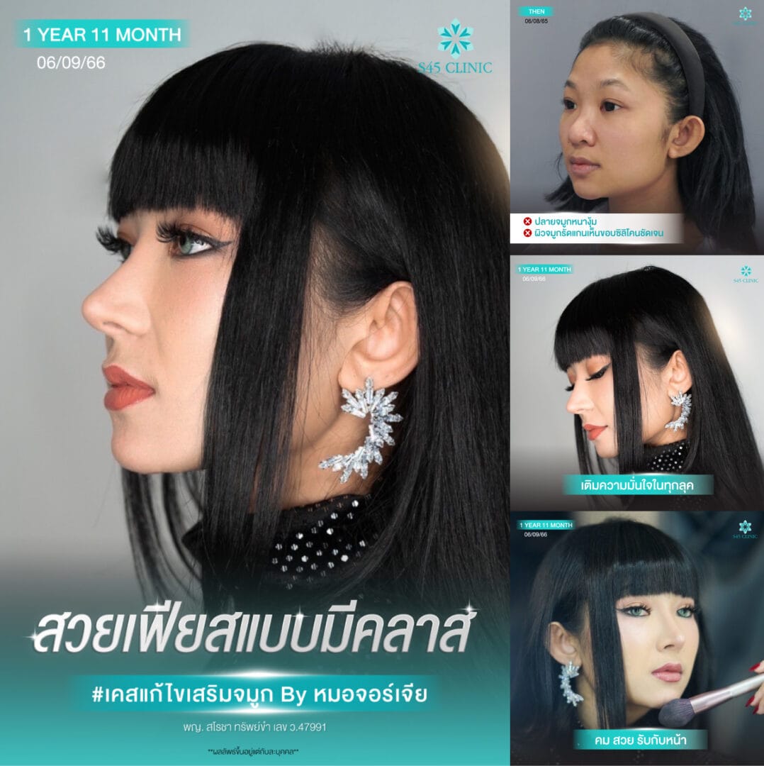 ทรงจมูกตุรกี S45 Clinic จมูกทรงยอดฮิตมัดใจสายฝอ